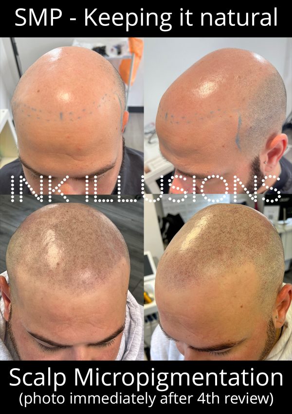 Scalp Micropigmentation (SMP) - Ink Illusions | Medical Tattooing Experts