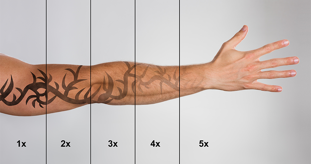 How Many Sessions Will I Need For Laser Tattoo Removal Ink Illusions How Many Sessions Will I Need For Laser Tattoo Removal Ink Illusions