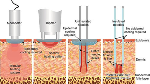 Fractional Radio Frequency Microneedling – The Jargon - Ink Illusions